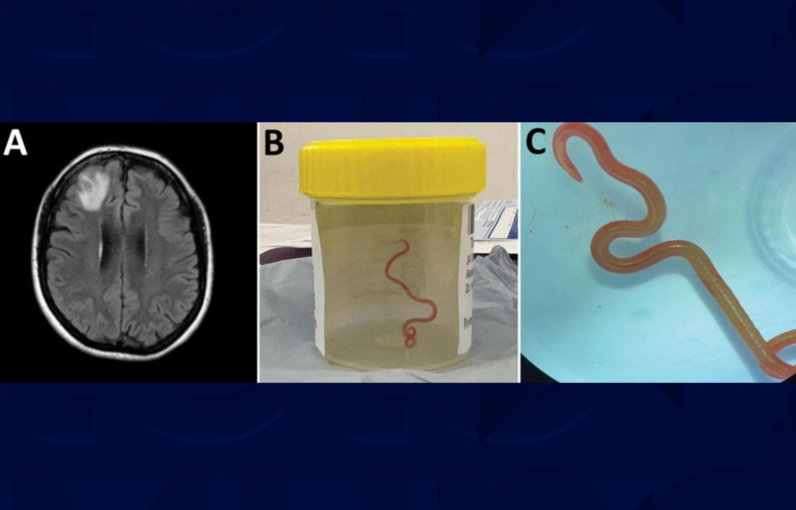 Neurocirujanos extrajeron del cerebro de una australiana una lombriz ...